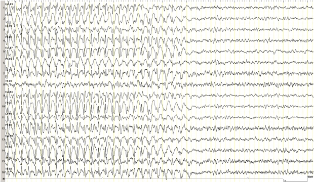 Rendimiento diagnóstico del EEG